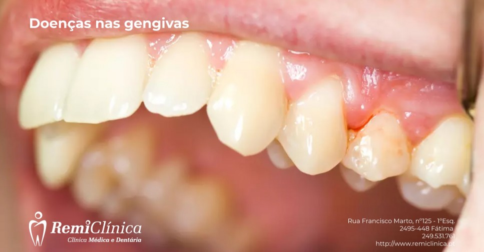 Remiclínica - Clinica Médica e Dentária | A doença na gengiva